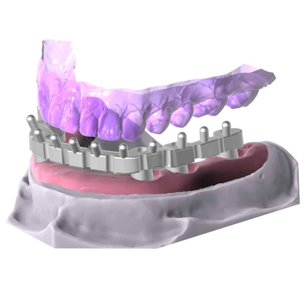 exocad tooth library ZRS module - Bristol CadCam